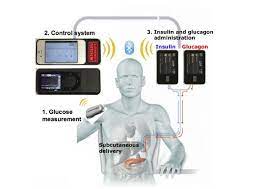 A “Bionic Pancreas” for Sort 1 Diabetes?